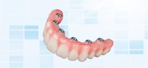 Hybrid Dentures – Stable & Natural-Looking Implant Solutions